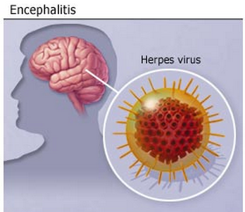 Εγκεφαλίτιδα: Συμπτώματα, πρόληψη και θεραπεία - HealthyLiving.gr