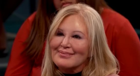 Παραμορφώθηκε από filler και ενημερώνει το κοινό για τους κινδύνους ...