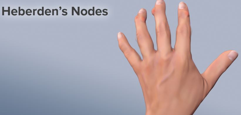 Οι όζοι Heberden σχετίζονται με την οστεοαρθρίτιδα γόνατος ...