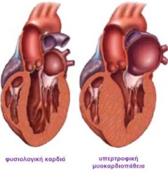 Τι είναι η υπερτροφική καρδιομυοπάθεια; - HealthyLiving.gr